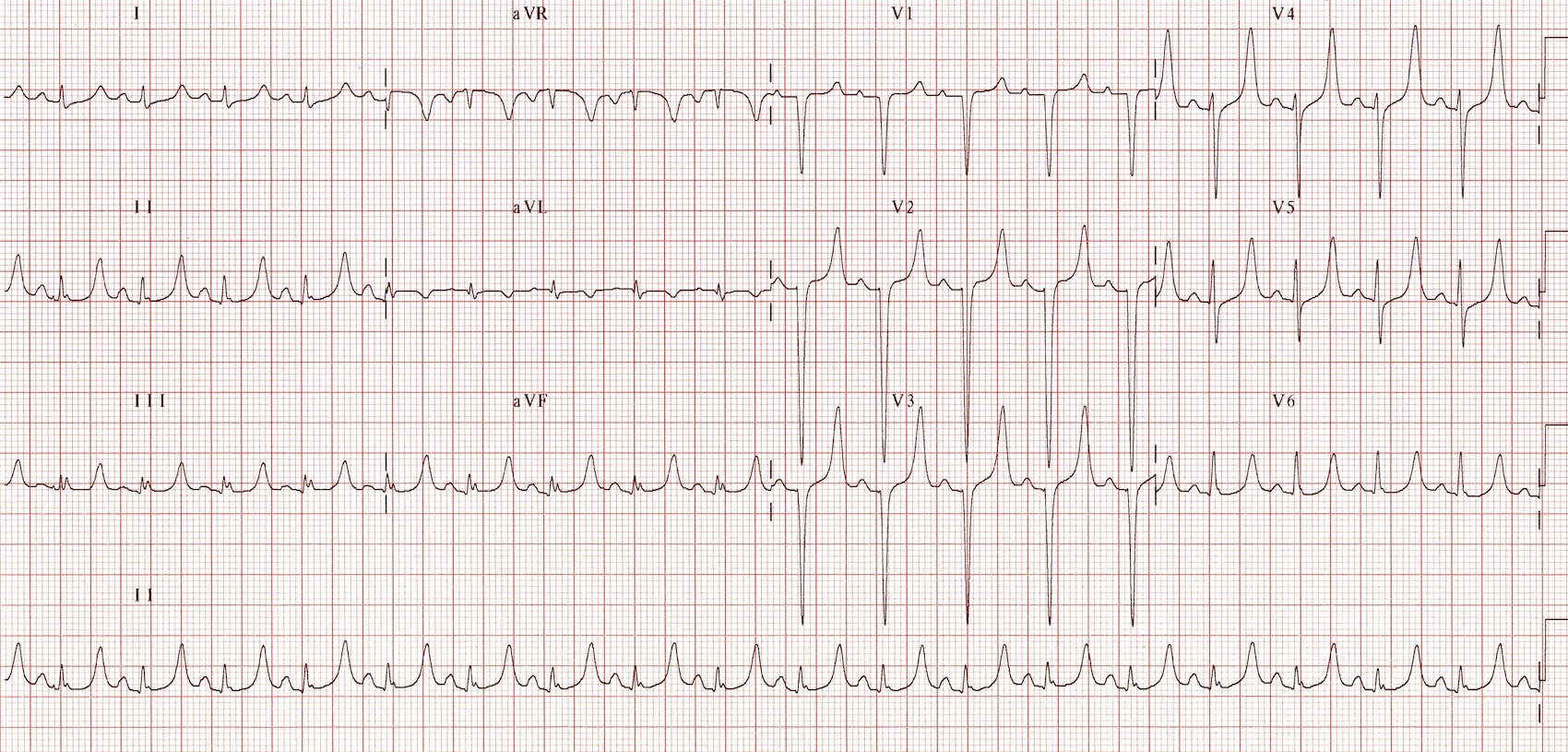 Ecg Potassium 7 Peaked T Waves Acilcinet
