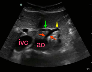 Odaklanmış Abdominal Aorta Ultrasonografisi - Acilci.Net