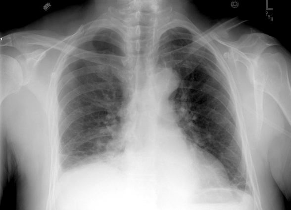 Toraks Projesi 1: Pnömotoraks - Acilci.Net