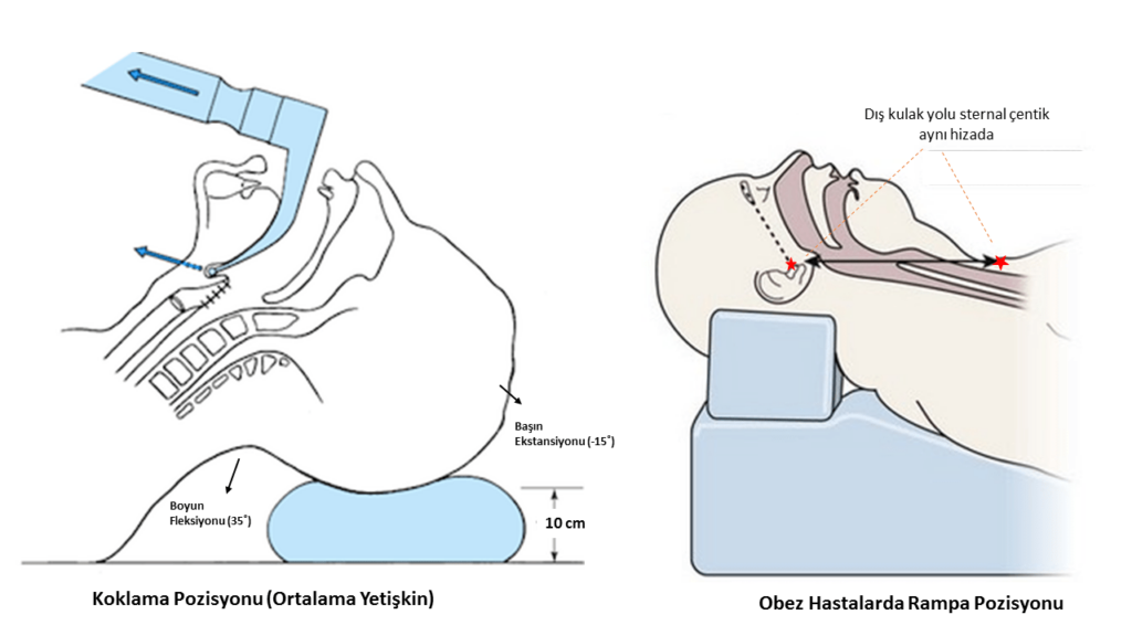 Ameliyathane Dışında Kritik Hasta Entübasyonu-2 - Acilci.Net