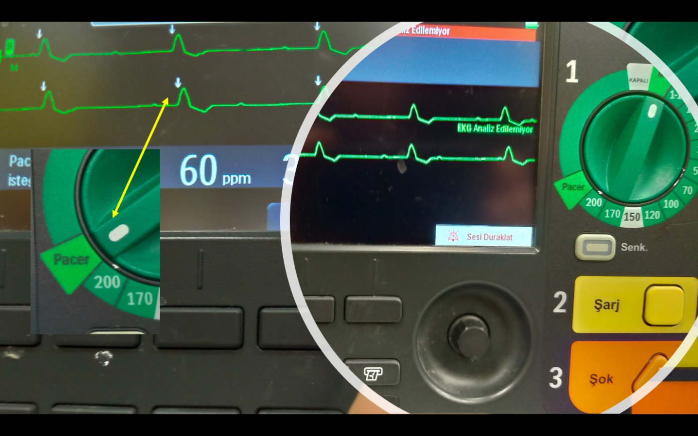 Transkutan Pacemaker Uygulaması - Acilci.Net