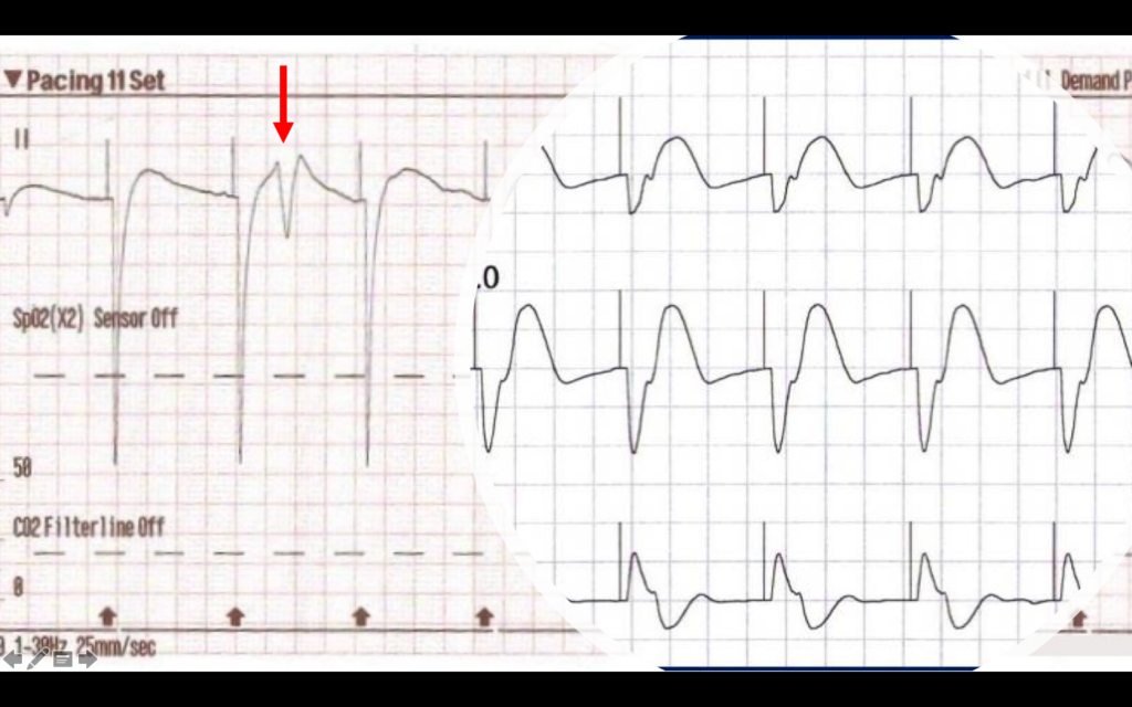 Transkutan Pacemaker Uygulaması - Acilci.Net