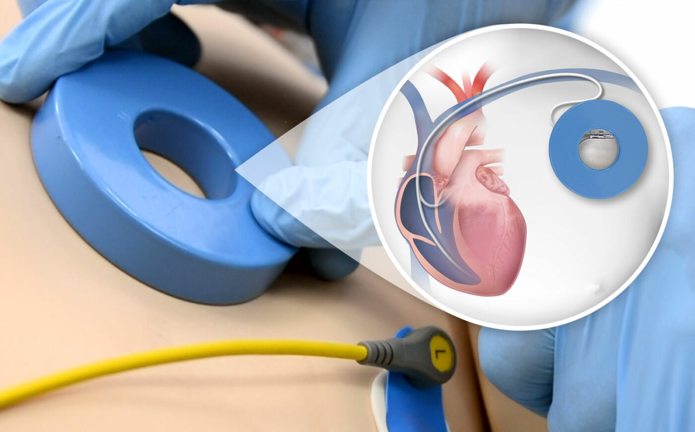 İmplante Edilebilir Kardiyoverter Defibrilatör (ICD) Şoklarının ...