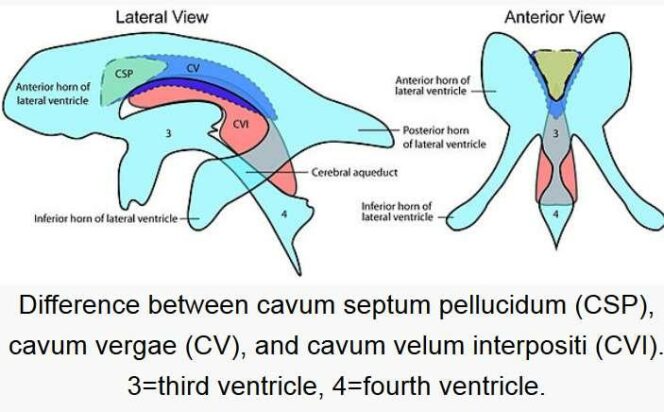 Cavum Vergae Varyasyonu Acilci Net