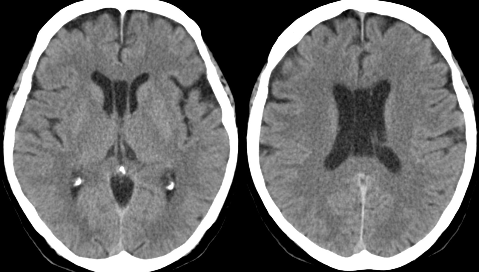 Cavum Vergae Varyasyonu - Acilci.Net