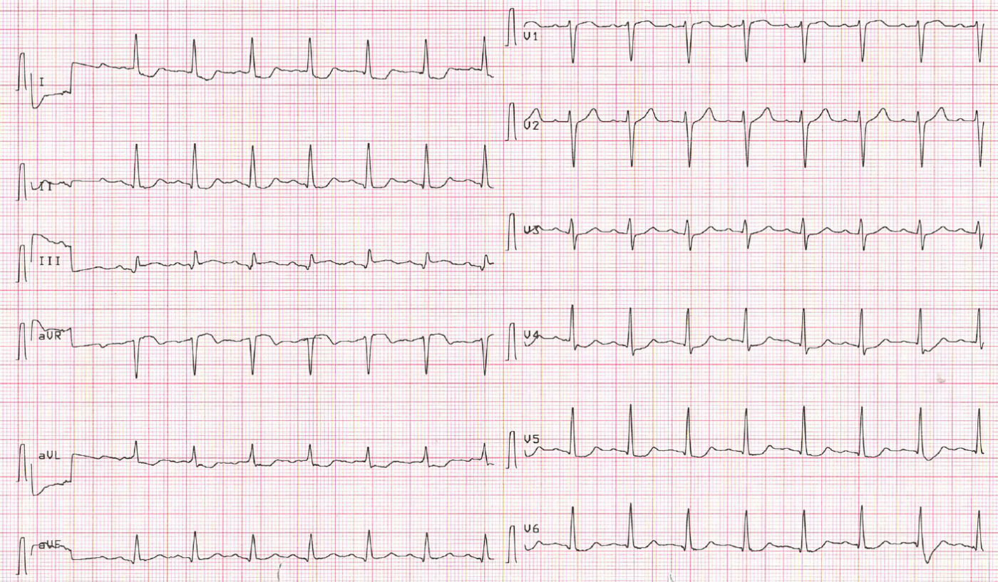 Erken İnferior STEMI Tanısında Aslanger Modeli - Acilci.Net