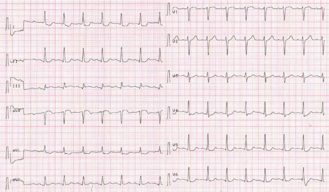 Erken İnferior STEMI Tanısında Aslanger Modeli - Acilci.Net