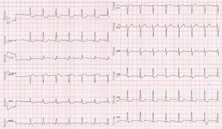 Erken İnferior STEMI Tanısında Aslanger Modeli - Acilci.Net