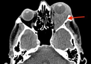 Orbital Kompartman Sendromu ve Lateral Kantatomi - Acilci.Net