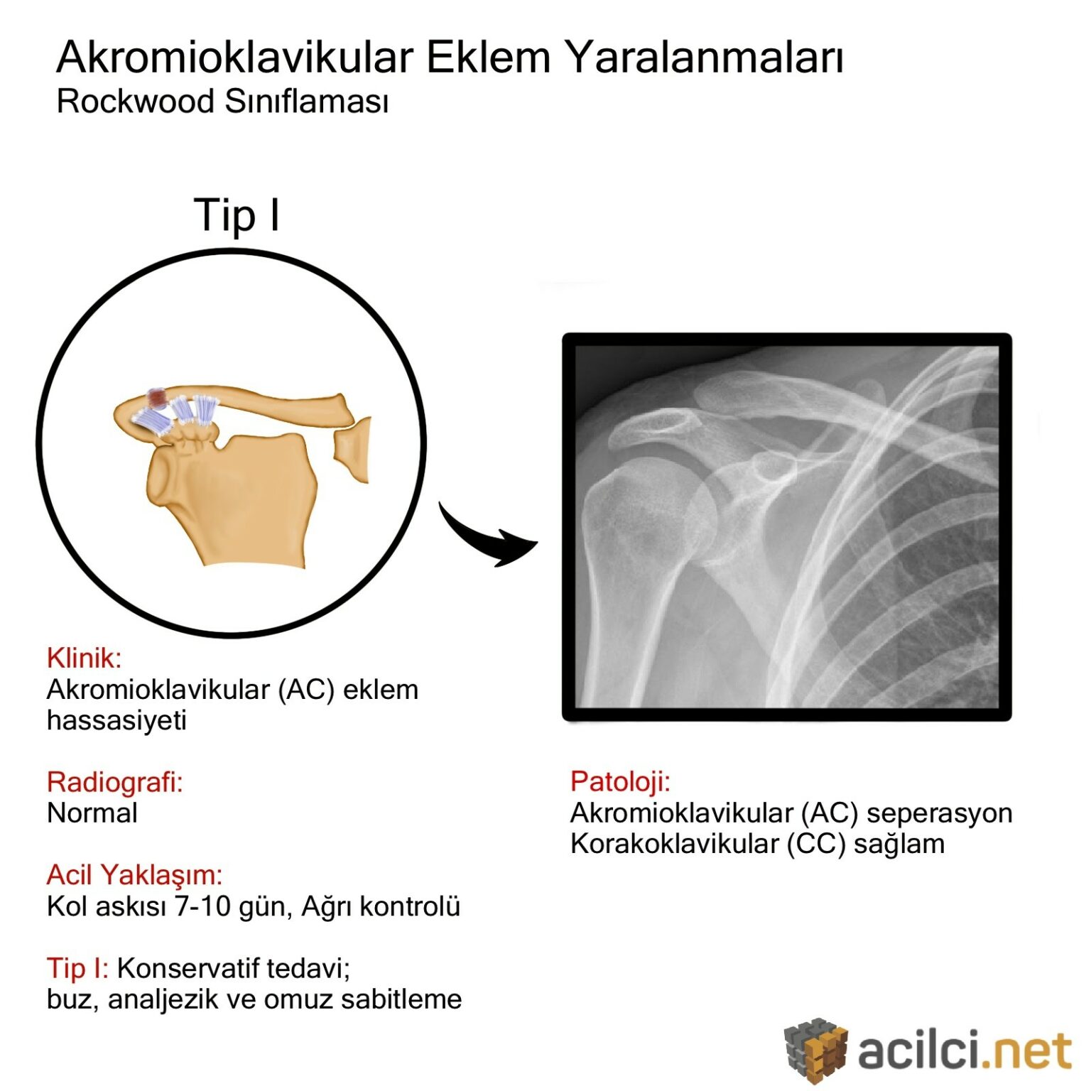 Akromioklavikular Eklem Yaralanmaları İllüstrasyonu - Acilci.Net