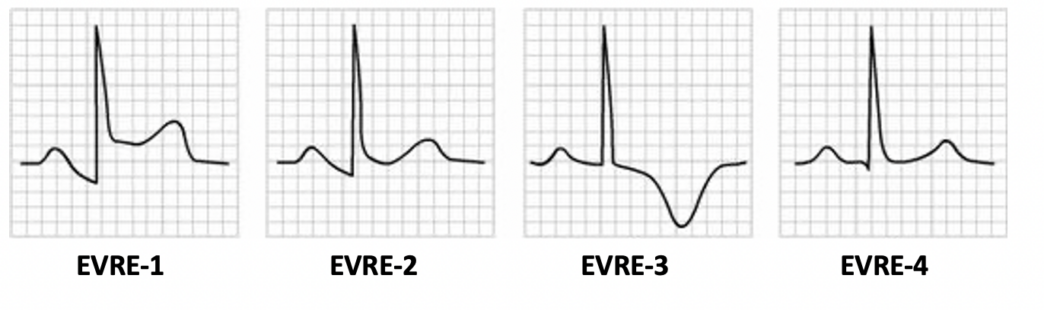 Akut Perikardit Tedavi ve Yönetimi - Acilci.Net