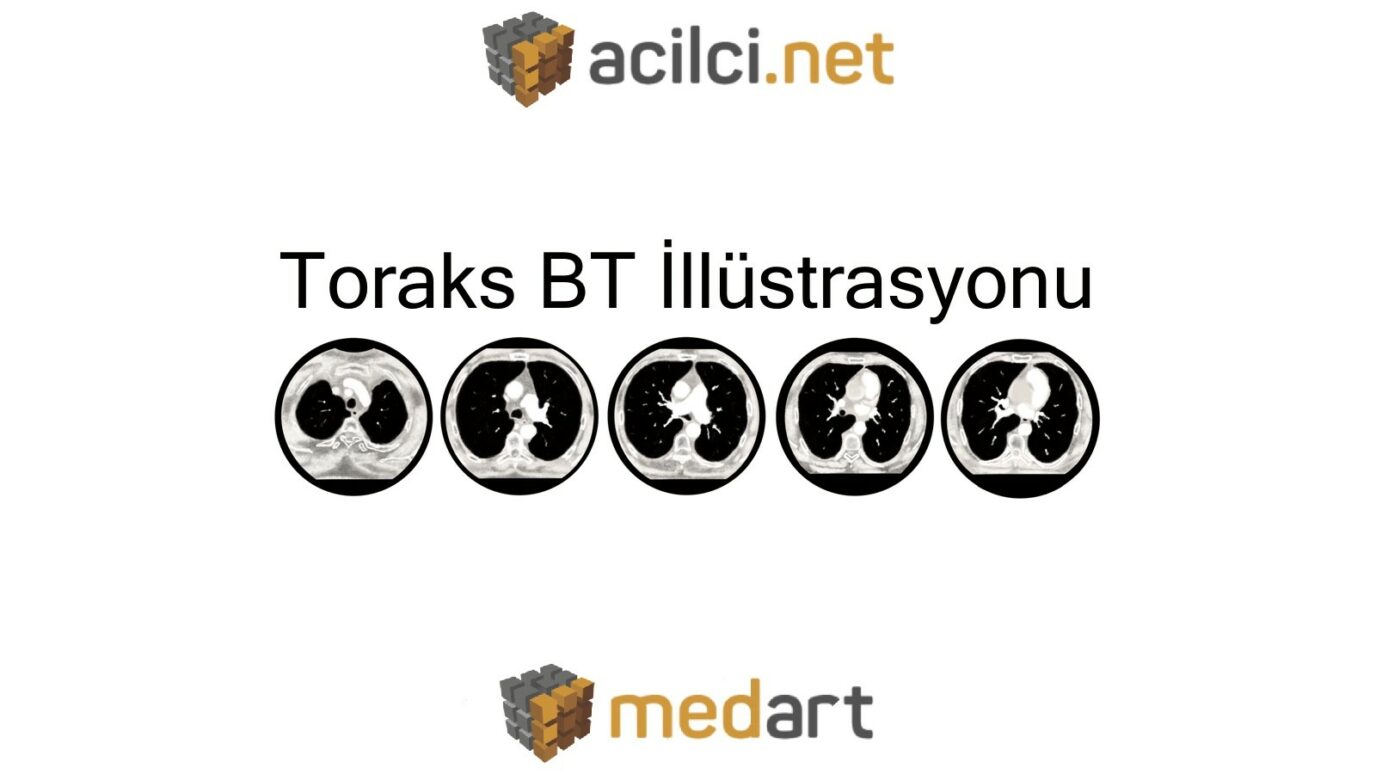 Toraks BT İllüstrasyonu - Acilci.Net