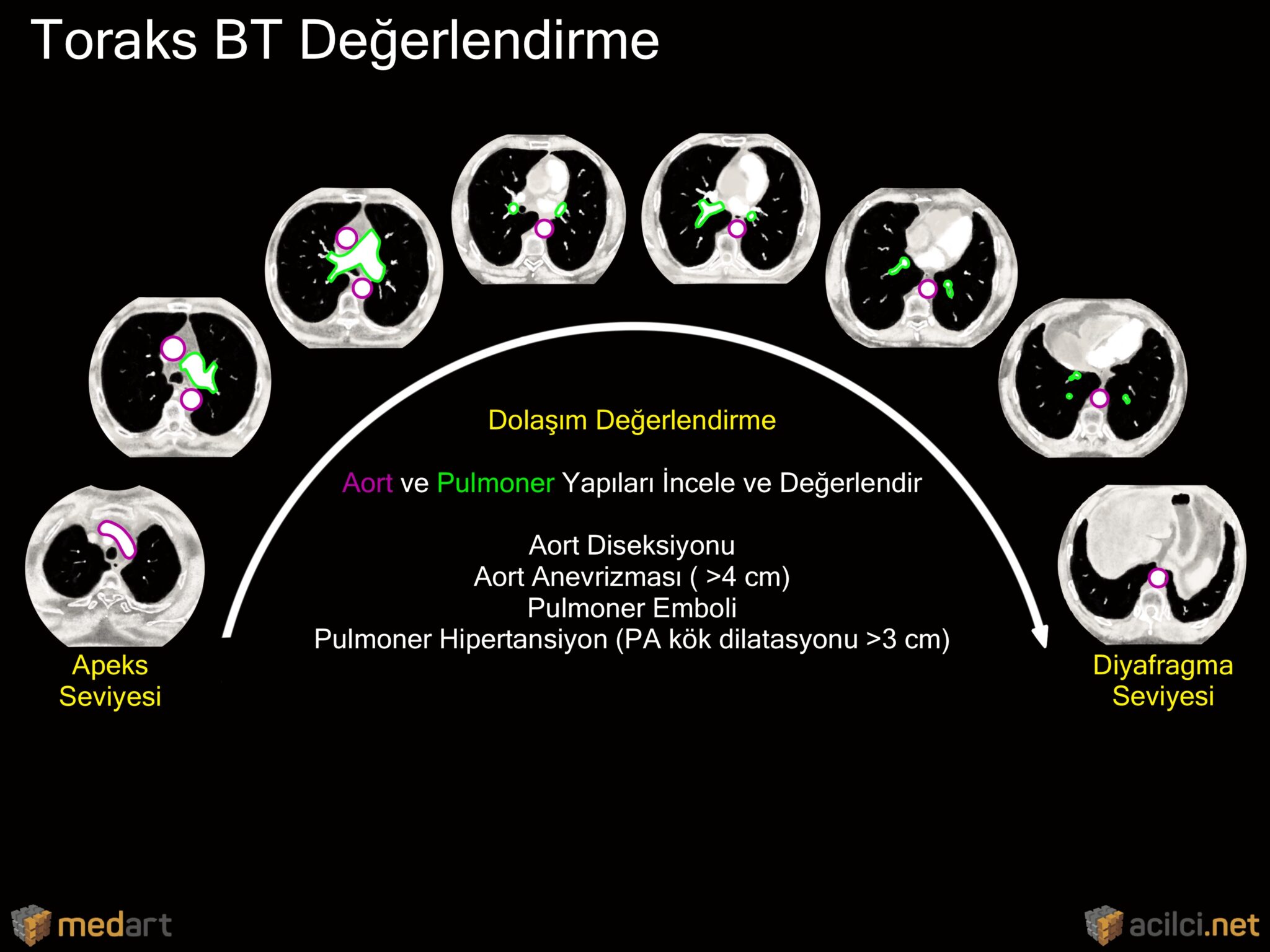 Toraks BT İllüstrasyonu - Acilci.Net
