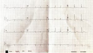 Sol dal bloğunda neden elevasyon görünür? - Acilci.Net