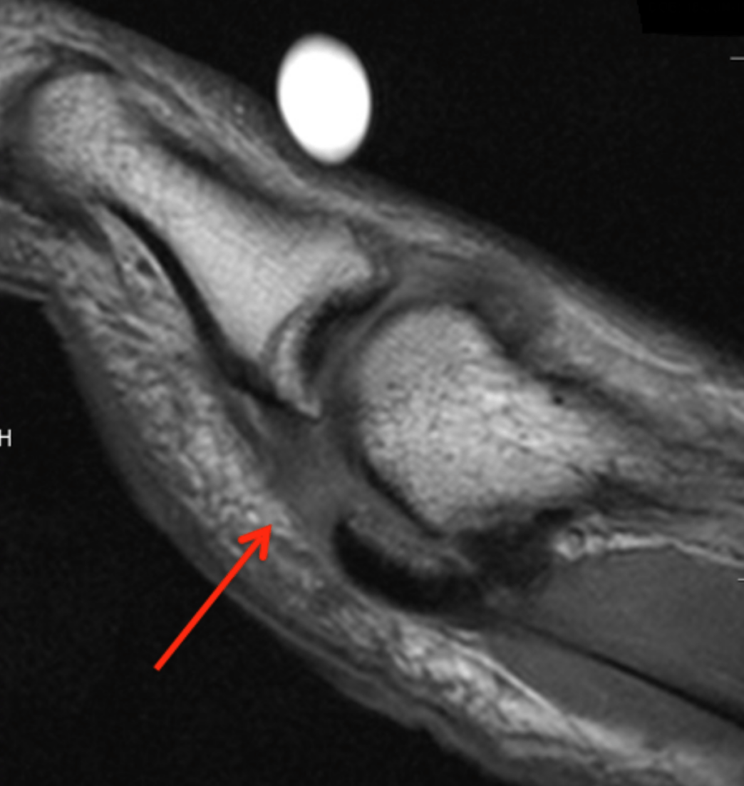 Turf Toe - Acilci.Net