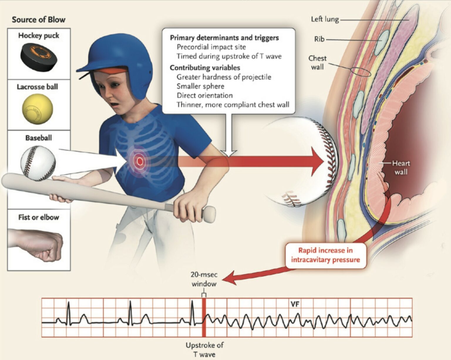 Commotio Cordis - Acilci.Net