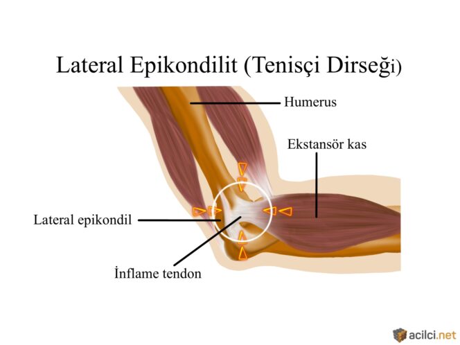 Sporda Dirsek Travmaları-Tenisçi Dirseği - Acilci.Net