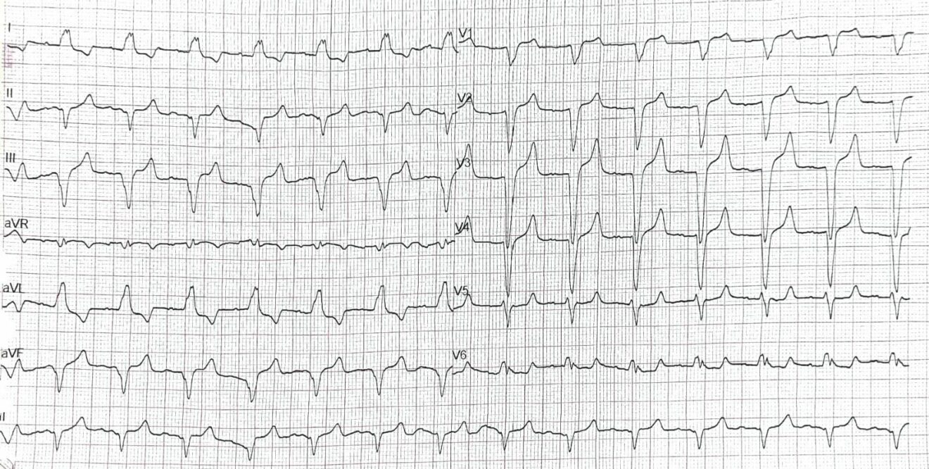 Sol dal bloğu ile başvuran hasta Lengere hastalığı olabilir mi ...