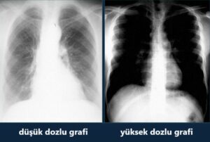 Acil Serviste Pediatrik Akciğer Grafisi Yorumlama - Acilci.Net