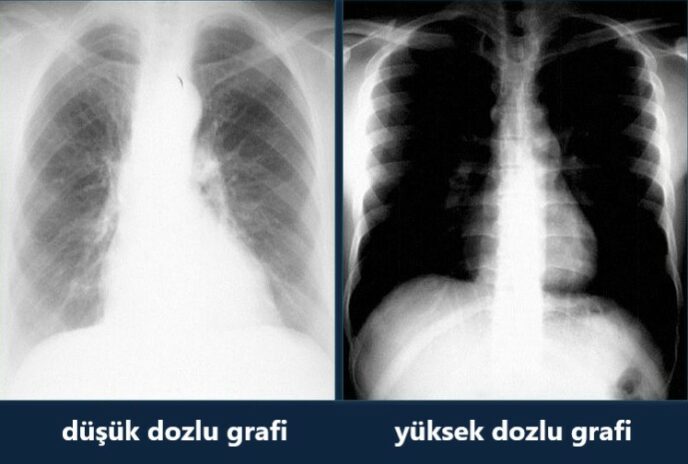 Acil Serviste Pediatrik Akciğer Grafisi Yorumlama - Acilci.Net