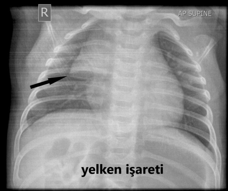 Acil Serviste Pediatrik Akciğer Grafisi Yorumlama - Acilci.Net
