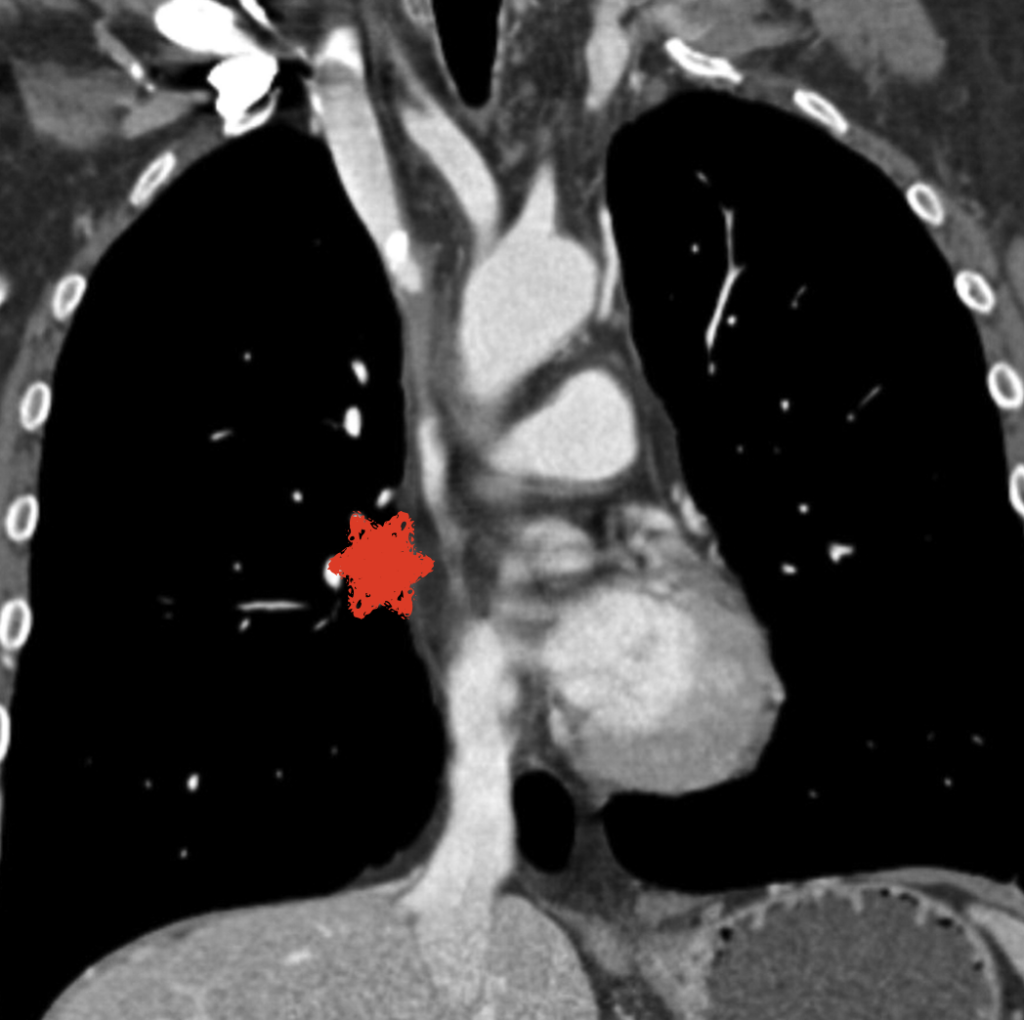 Vena Kava Superior Sendromu - Acilci.Net