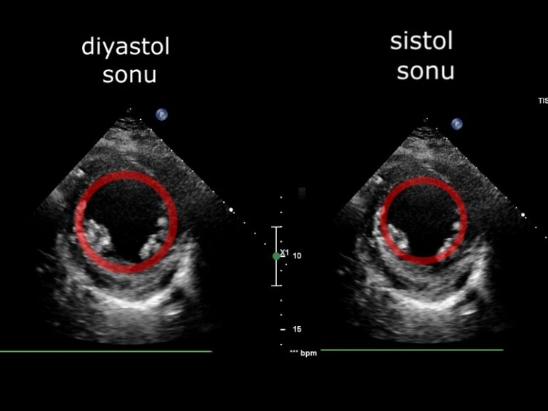 Sol Ventrikül Sistolik Fonksiyonunun Görsel Değerlendirilmesi - Acilci.Net