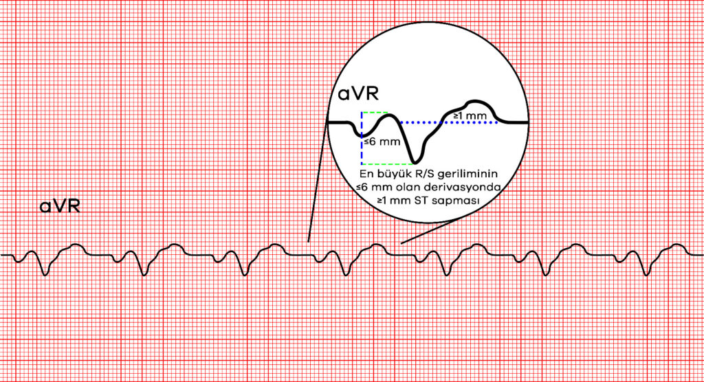 Sgarbossa Kriterleri mi? Barcelona Algoritması mı? - Acilci.Net