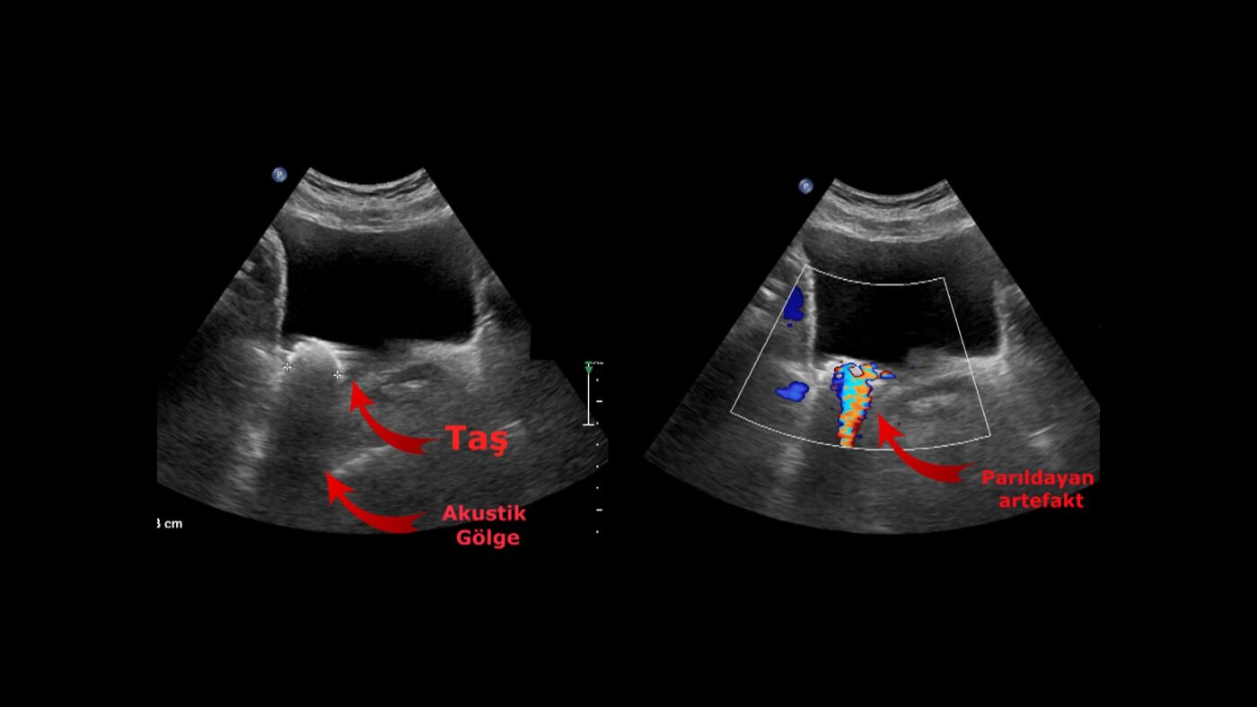 Üriner Sistem Taşlarında Parıldayan Artefakt-Twinkling Görüntüsü - Acilci.Net