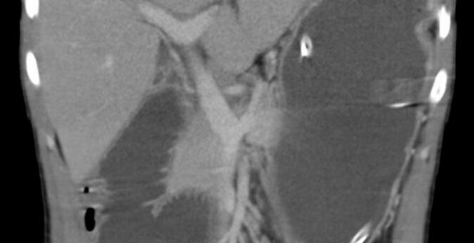 Süperior Mezenter Arter Sendromu - Acilci.Net