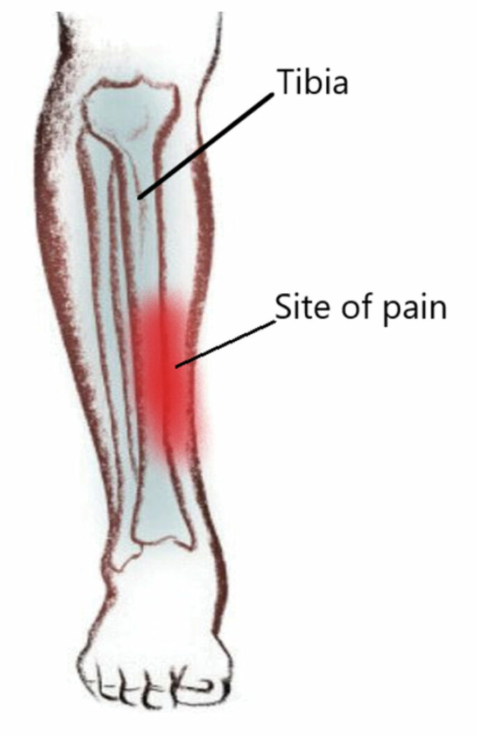 Medial Tibial Stres Sendromu - Acilci.Net